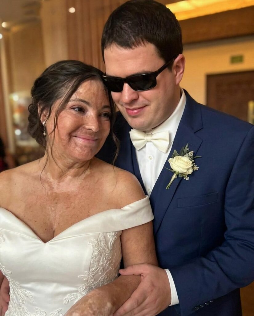 I Married a Blind Man So He’d Never See My Scars — But on Our Wedding ...